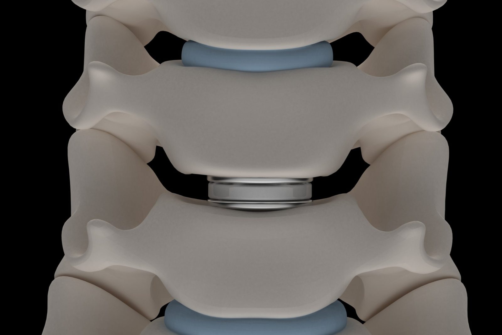 Artificial Disc Replacement In NJ | Comprehensive Spine Care