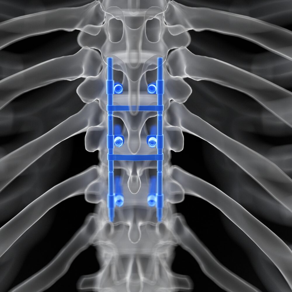 The Differences Between Cervical Foraminotomy And Discectomy | New ...