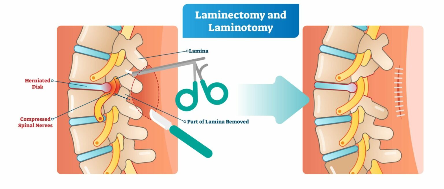 The Difference Between A Laminectomy And A Laminotomy | New Jersey ...