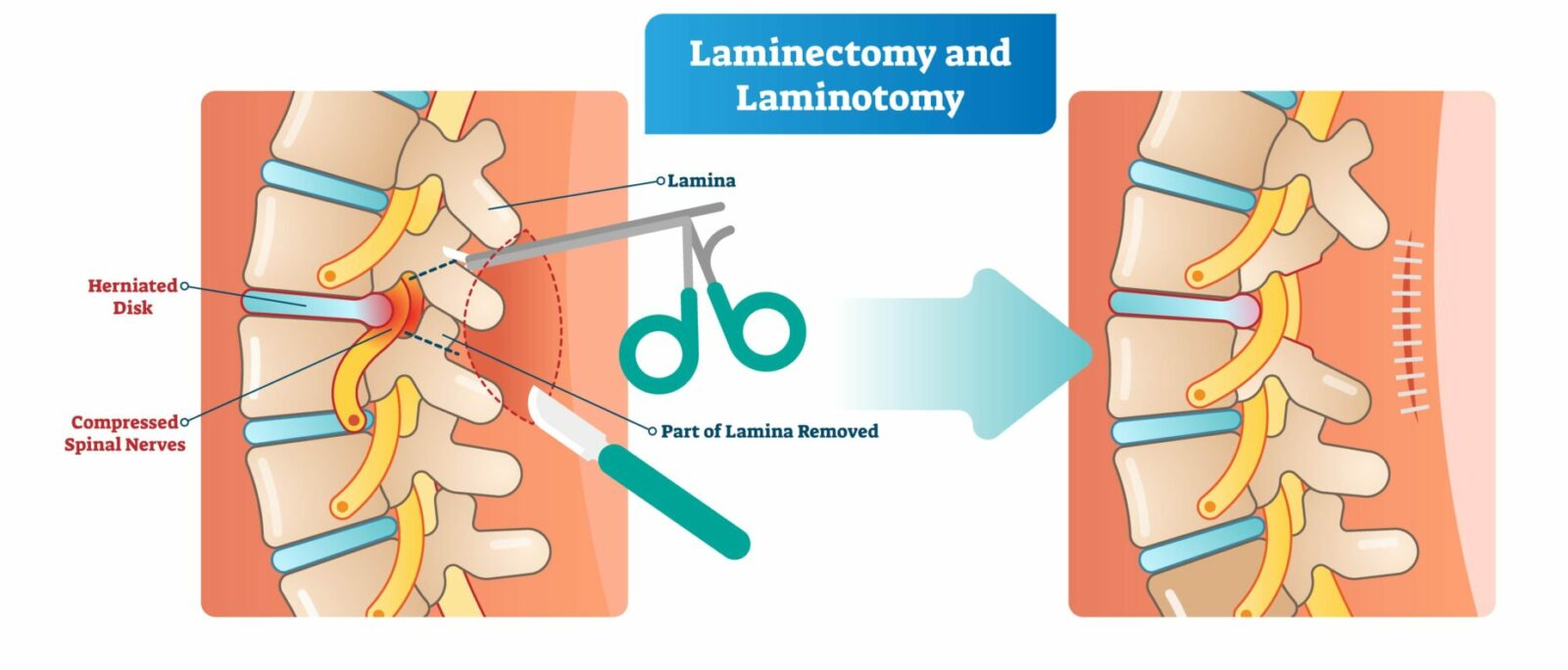 Hemilaminectomy Laminectomy Spine Info Hemilaminectomy Laminectomy Spine Info