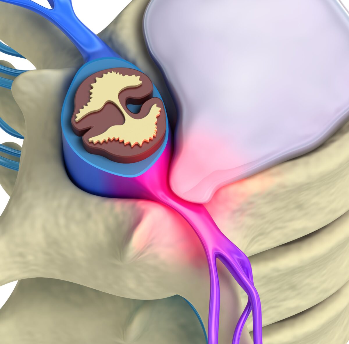 Herniated Thoracic Discs: What You Need To Know | New Jersey ...