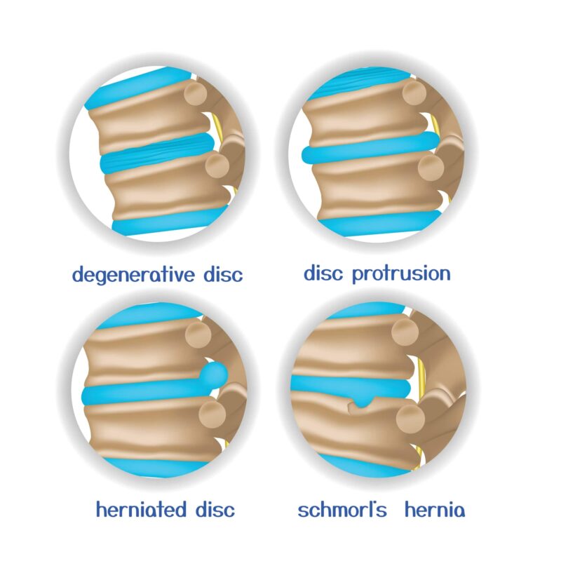 Understanding Four Common Spinal Disc Conditions | New Jersey ...