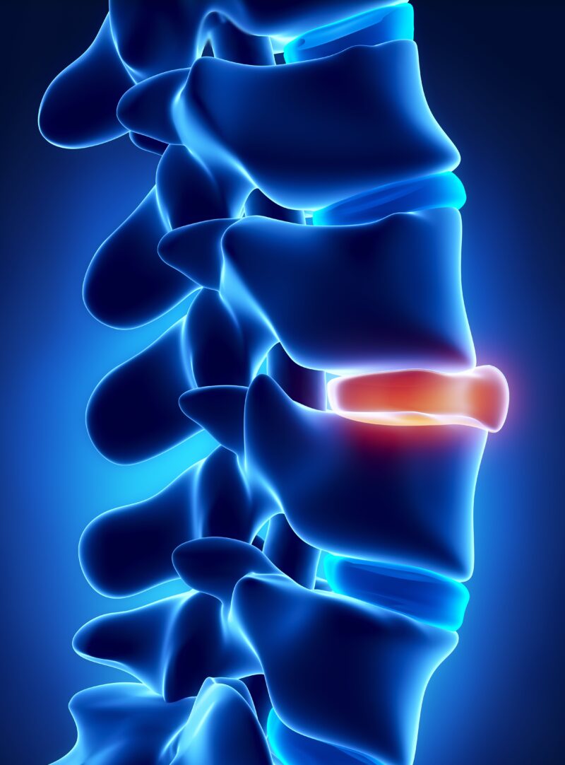 Herniated Vs. Bulging Disc: What's The Difference? | New Jersey ...