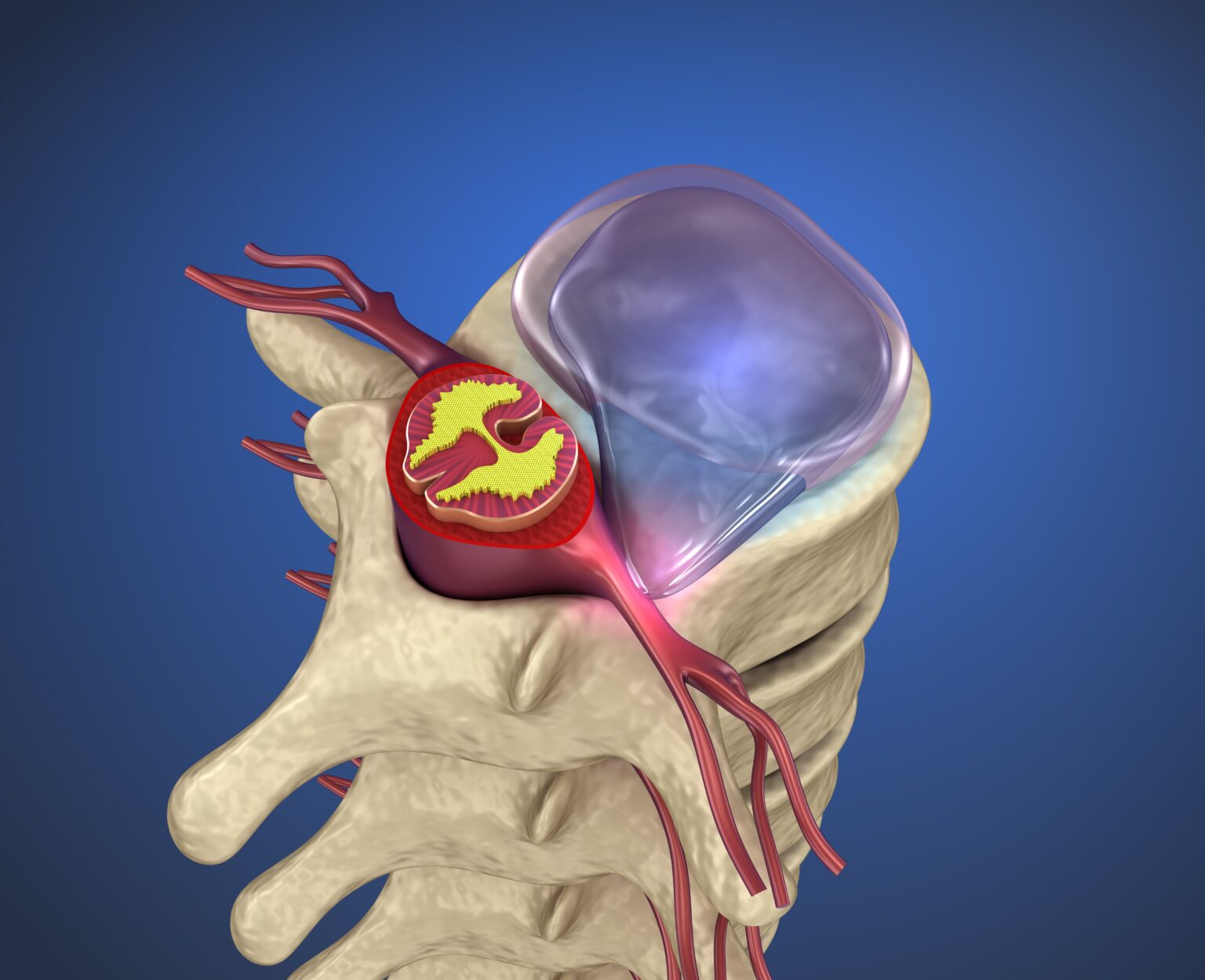 Herniated Vs. Bulging Disc: What's The Difference? | New Jersey ...