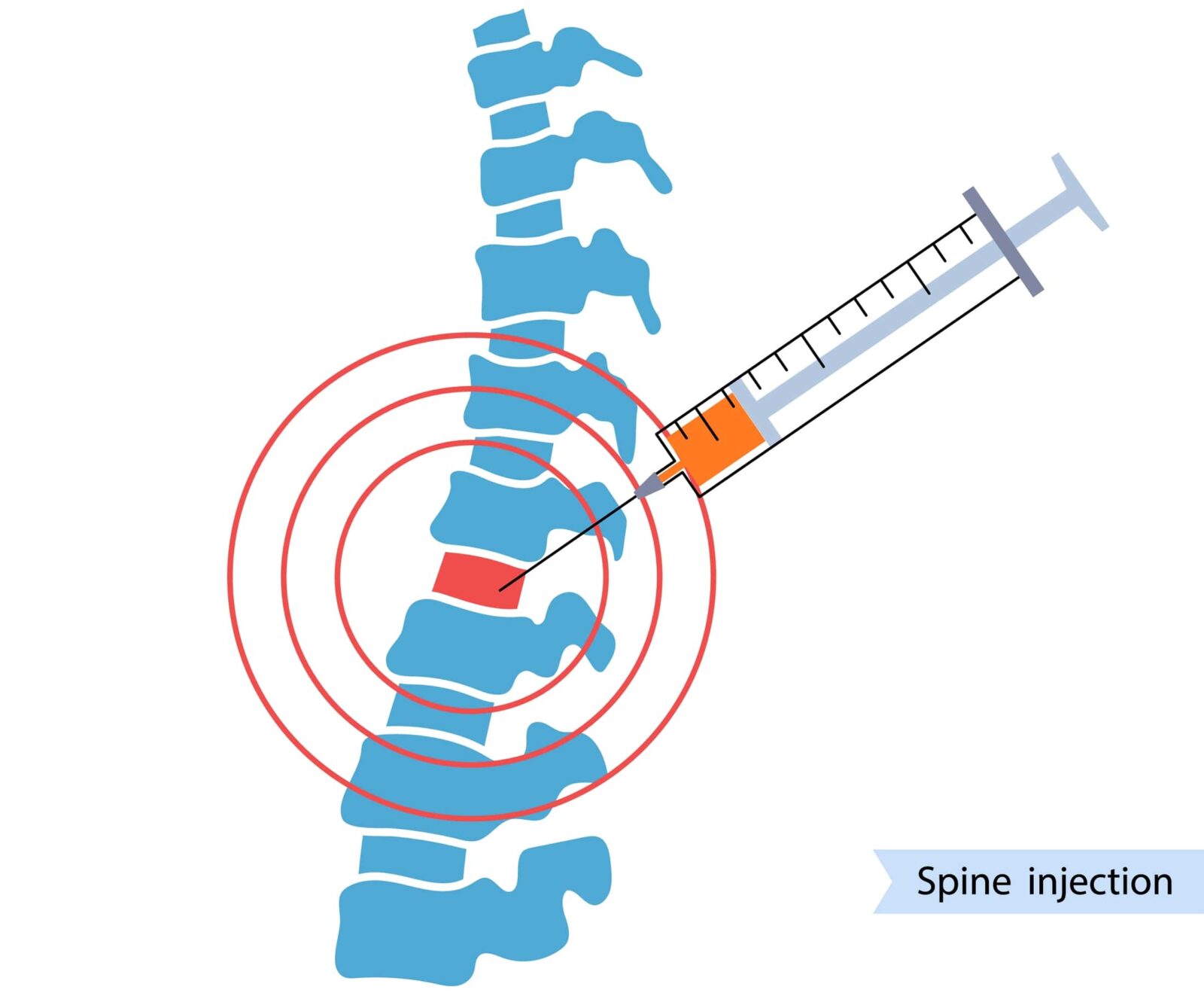 What Is An Intradiscal Injection? | New Jersey | Comprehensive Spine Care