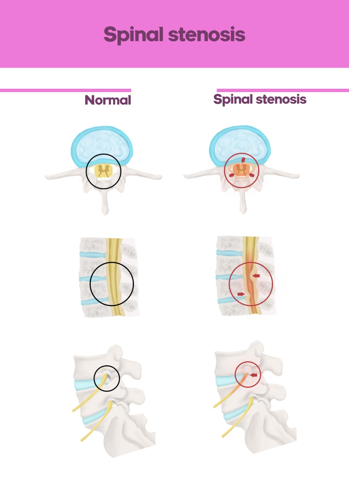 Exploring The Array Of Treatments For Spinal Stenosis: Relieving The ...
