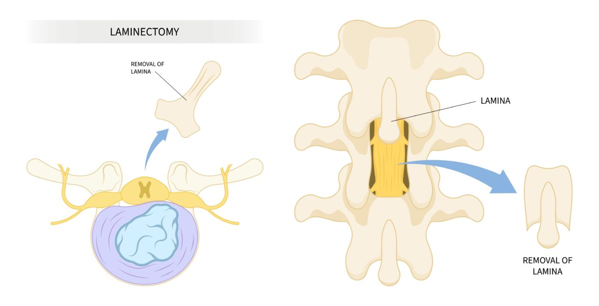 What Is The Difference Between Forminotomy, Discectomy, And Laminectomy ...