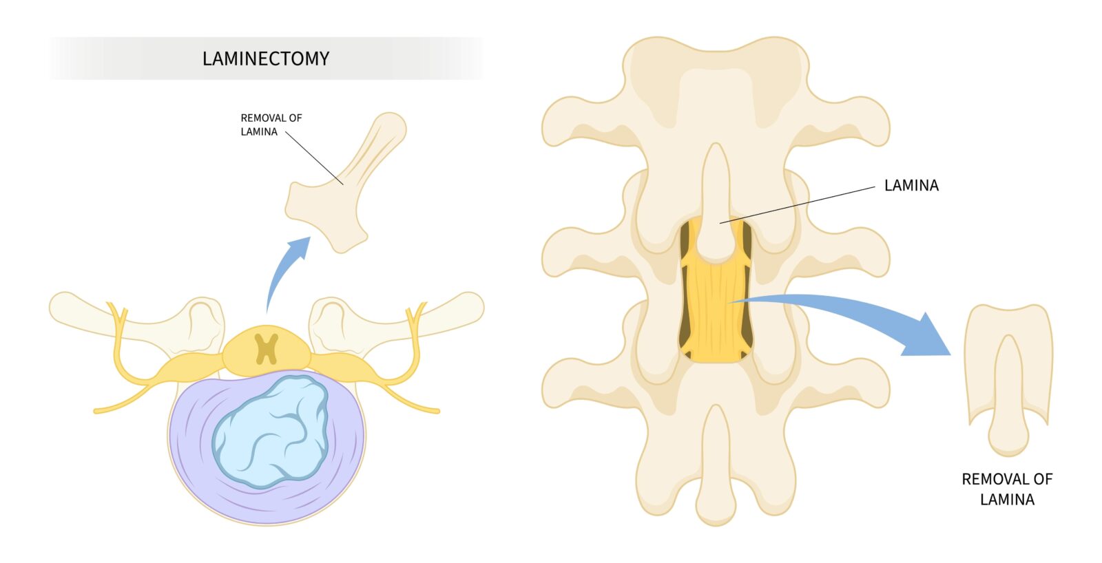 Endoscopic Discectomy Laminotomy At Joan Leet Blog