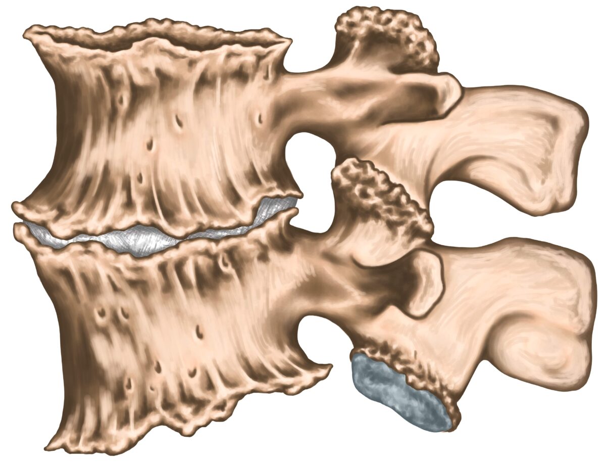 What Is Adjacent Segment Disease? | New Jersey | Comprehensive Spine Care