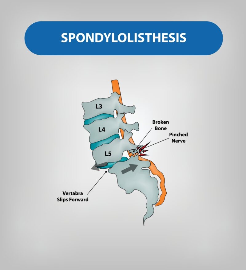 Types Of Spondylolisthesis: Distinguishing Between Congenital, Isthmic, And Degenerative | New ...