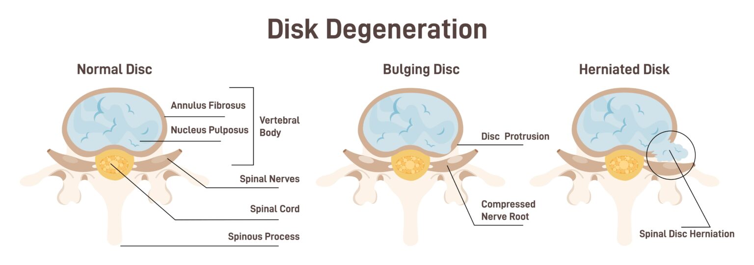 What Causes Bulging Discs? | New Jersey | Comprehensive Spine Care