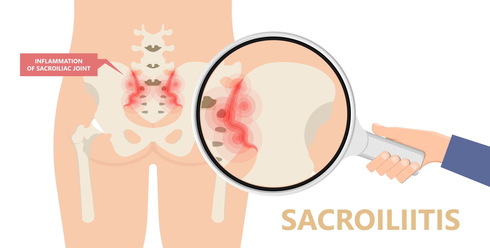 Sacroilitis Vs. Sciatica: What's The Difference? | New Jersey | Comprehensive Spine Care