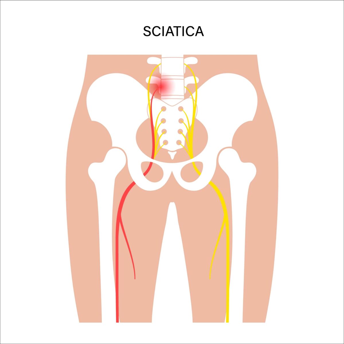 Sacroilitis Vs. Sciatica: What's The Difference? | New Jersey | Comprehensive Spine Care