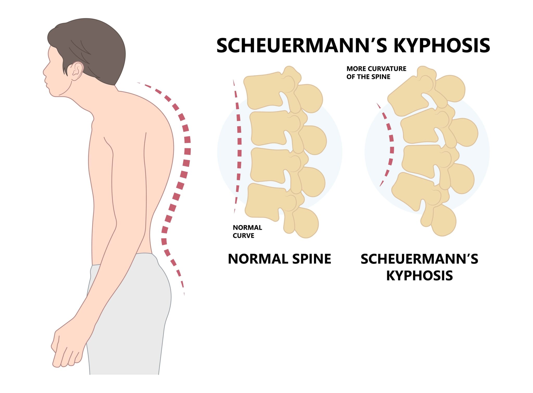 What Is Scheuermann's Disease? | New Jersey | Comprehensive Spine Care