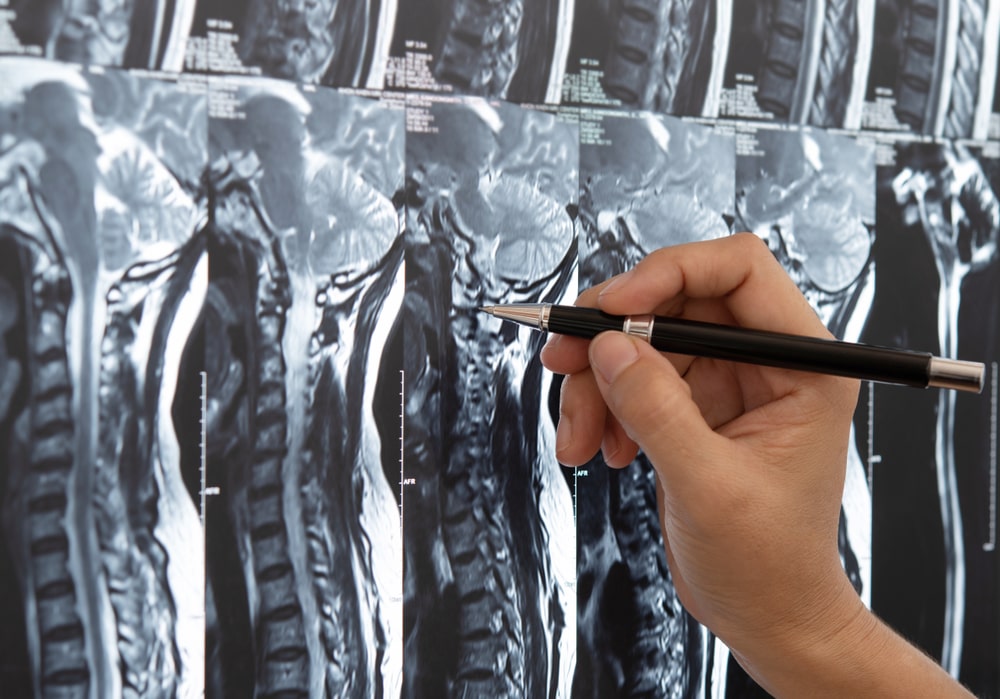 Minimally Invasive Spine Surgery Candidates