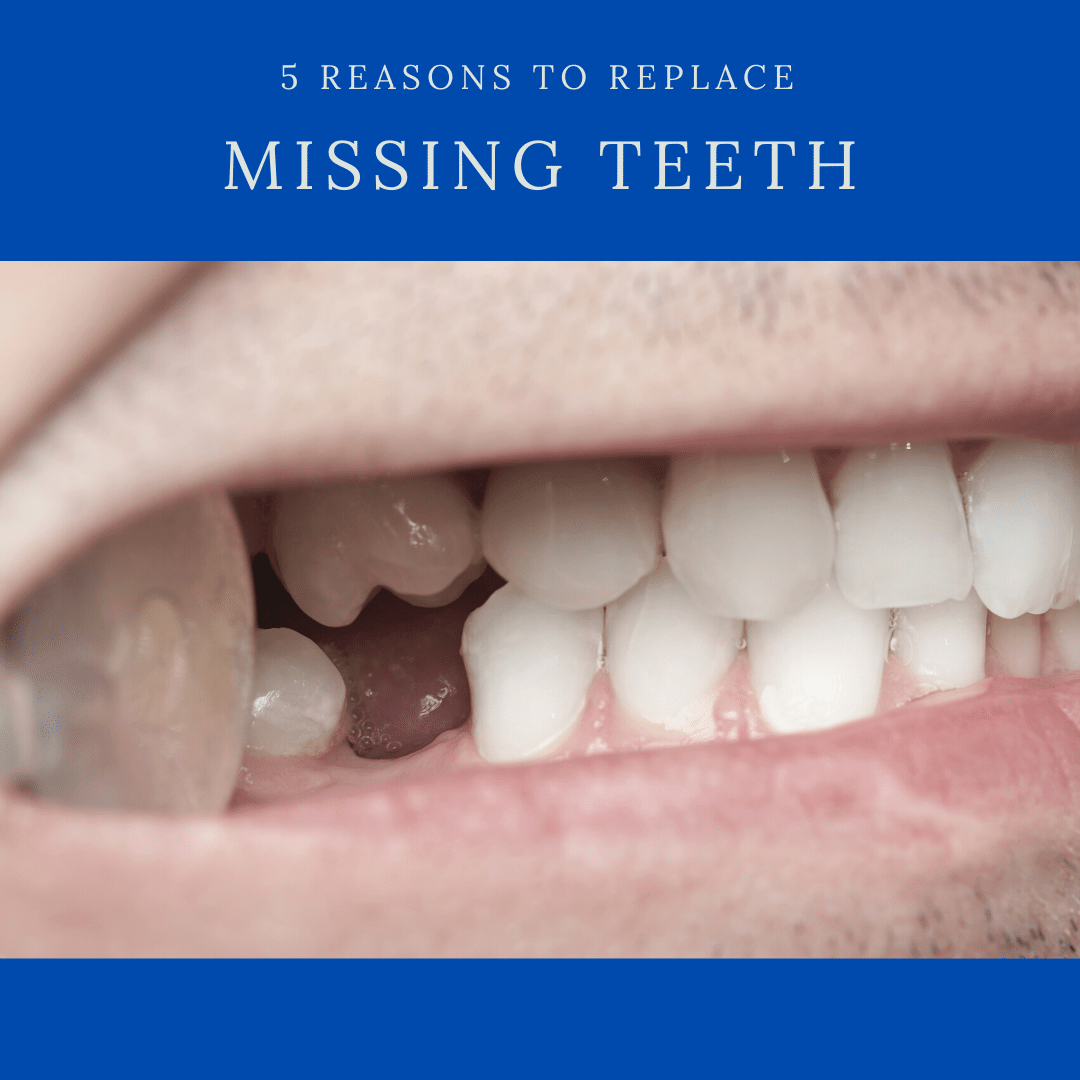 5 Reasons To Replace Missing Teeth Birch Point Dental Clinic 