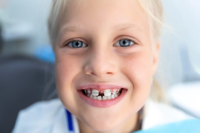 What Are Over-Retained Baby Teeth? | Acorn Dentistry For Kids