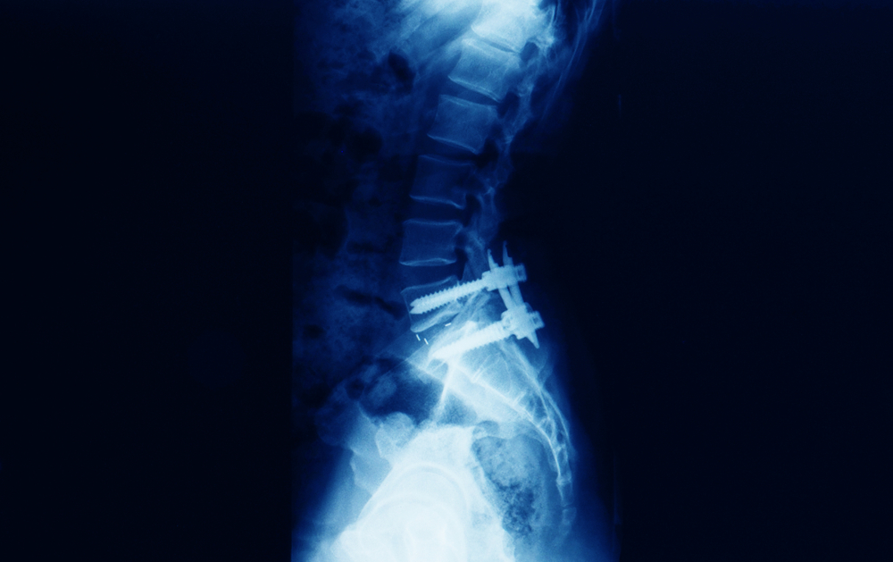 Transforaminal Lumbar Interbody Fusion (TLIF) | John K. Czerwein, MD ...