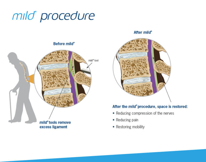 MILD Procedure • Trusha Shah, MD