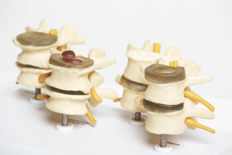 Posterior Cervical Fusion • Boston Spine And Scoliosis