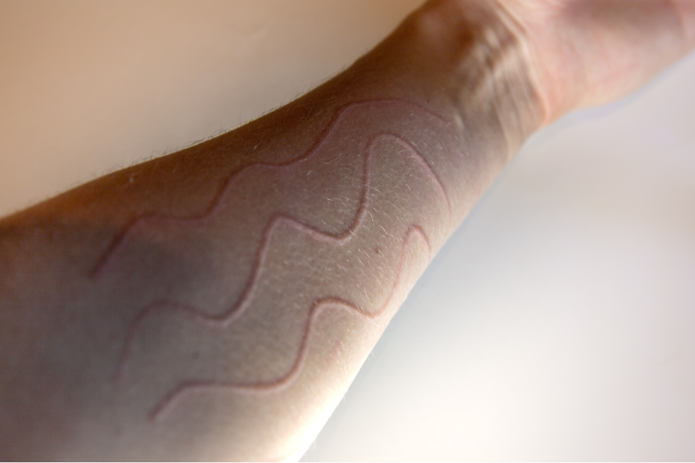 What is Dermatographism? | Allergy & Asthma | Tallahassee, FL