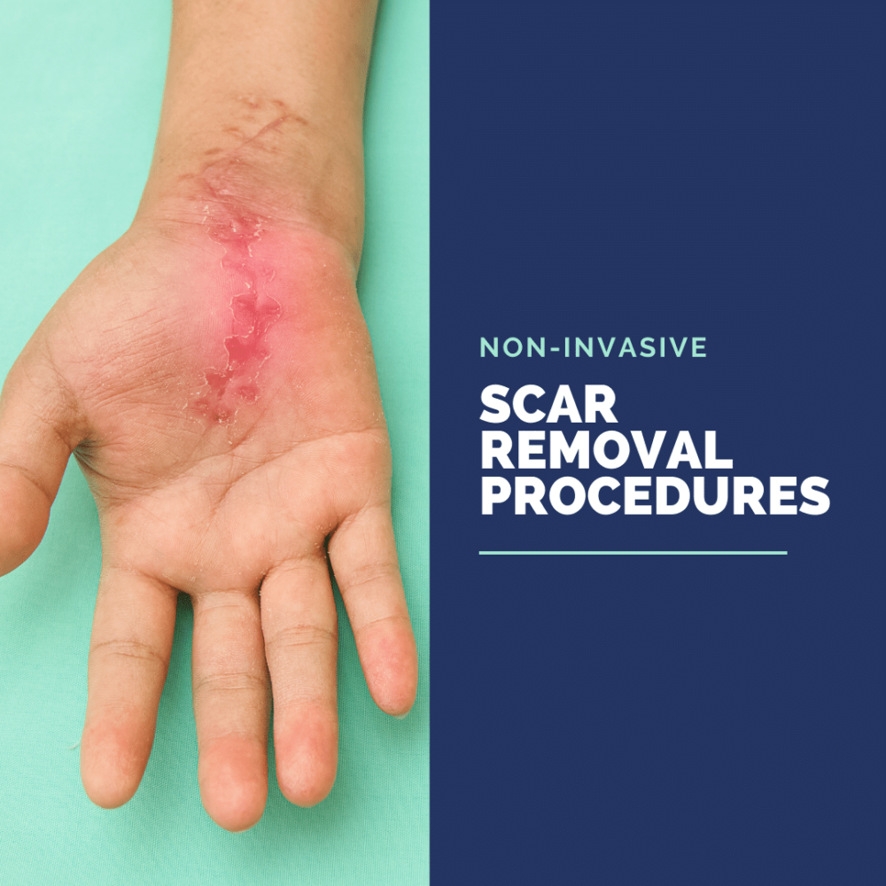 Non-Invasive Scar Removal Procedures | Annapolis and Severna Park, MD