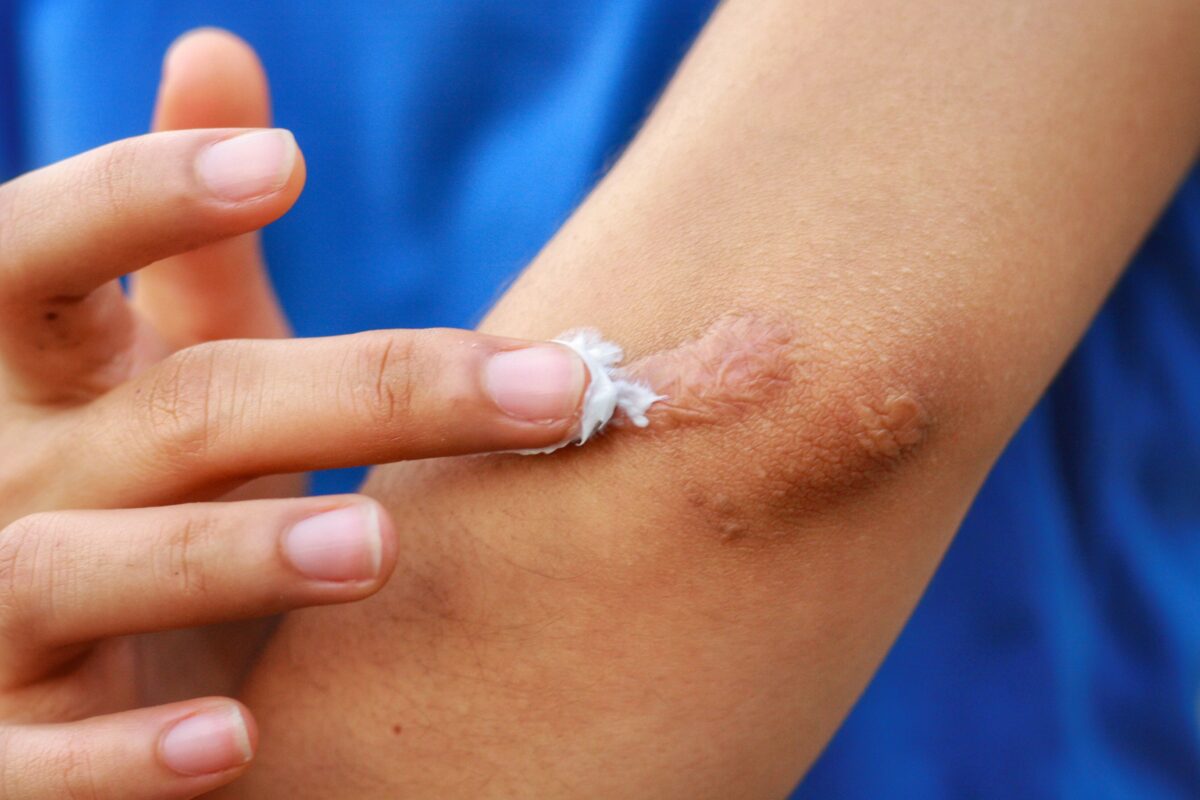 Non-Invasive Scar Removal Procedures | Annapolis and Severna Park, MD