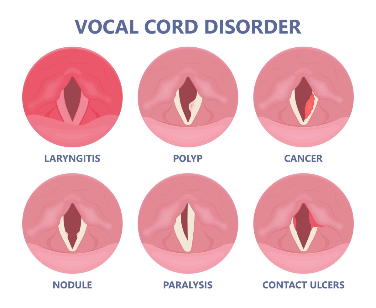 Understanding Vocal Cord Dysfunction: Laryngoscopy vs. Videostroboscopy ...
