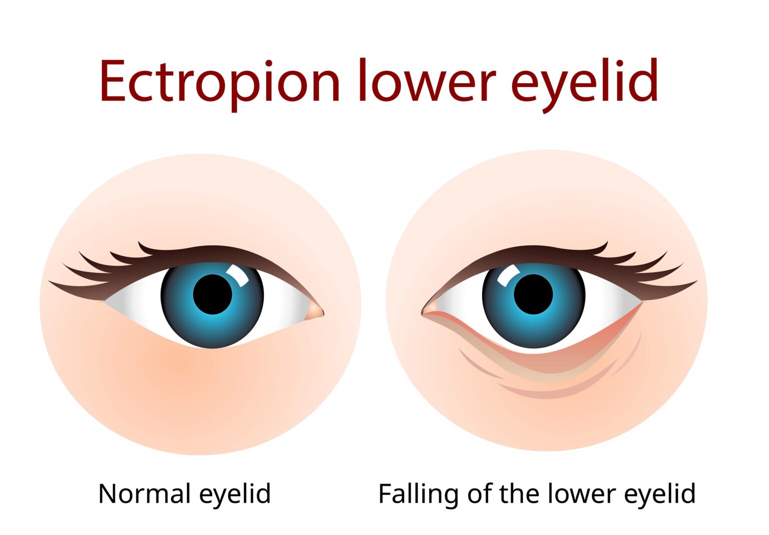 Understanding Eyelid Malposition: Causes, Symptoms, and Treatment ...