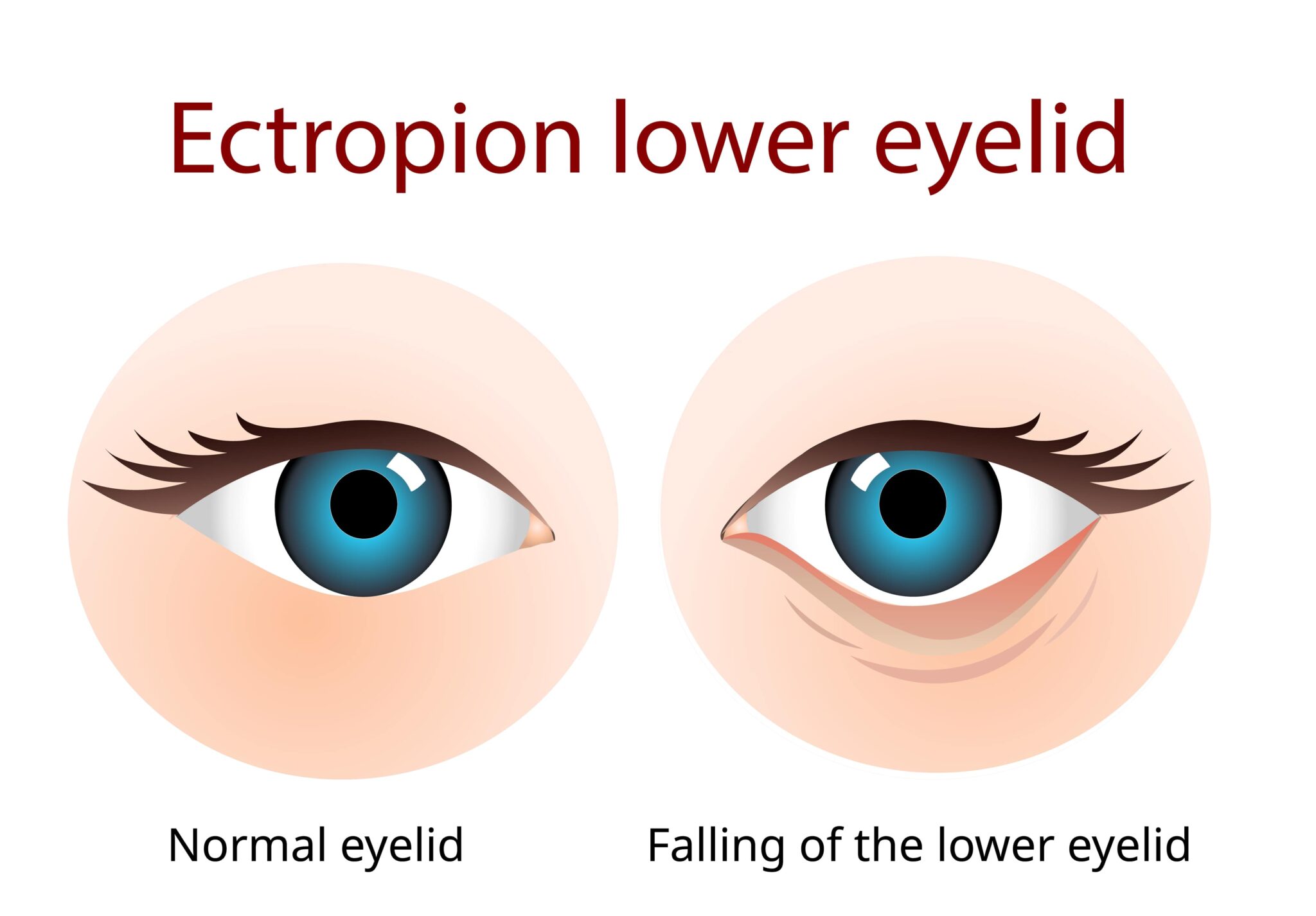 Understanding Eyelid Malposition: Causes, Symptoms, and Treatment ...