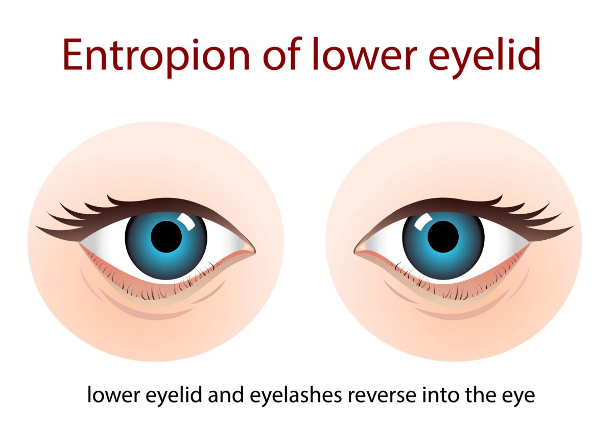 Understanding Eyelid Malposition: Causes, Symptoms, and Treatment ...