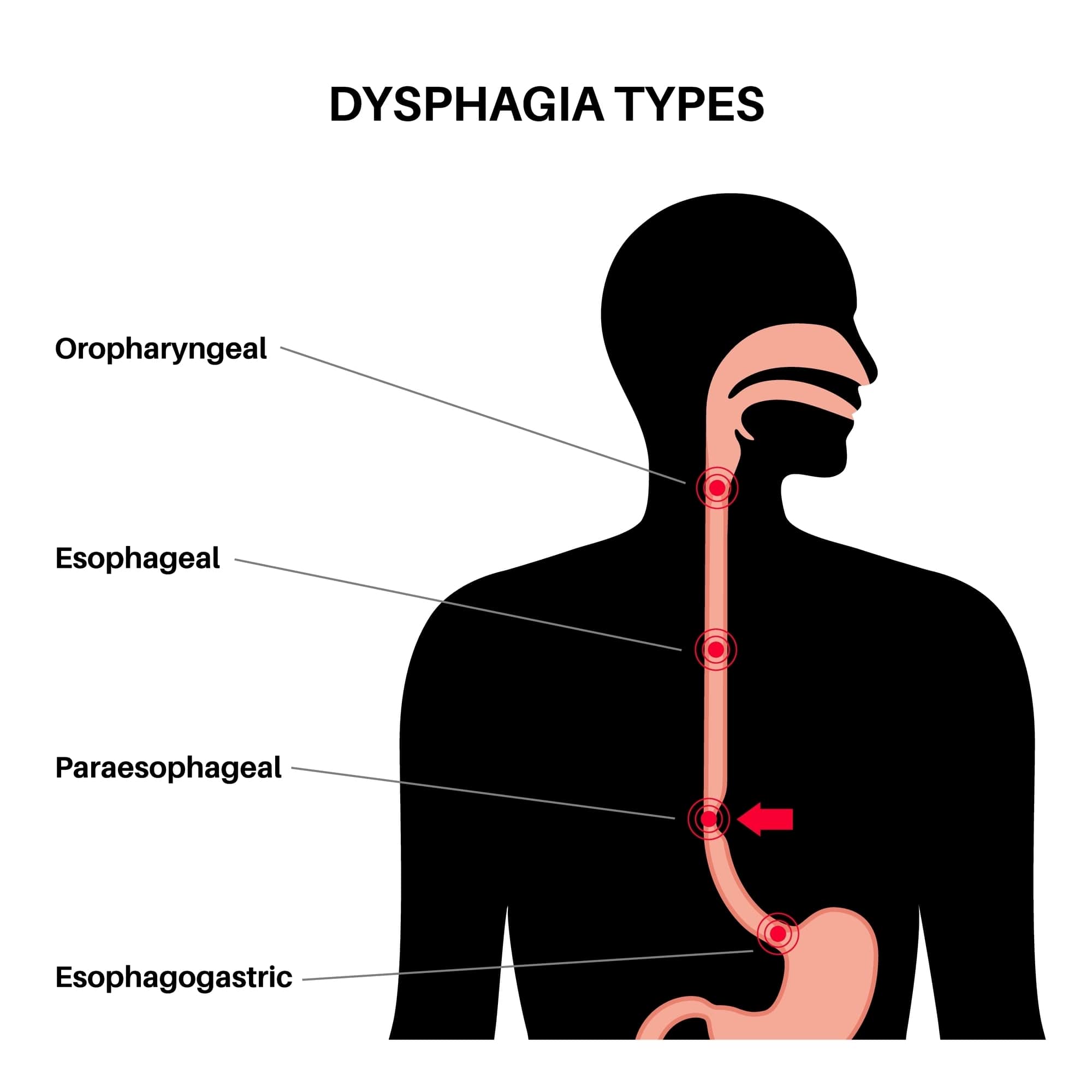 Understanding the Difference Between Odynophagia and Dysphagia ...