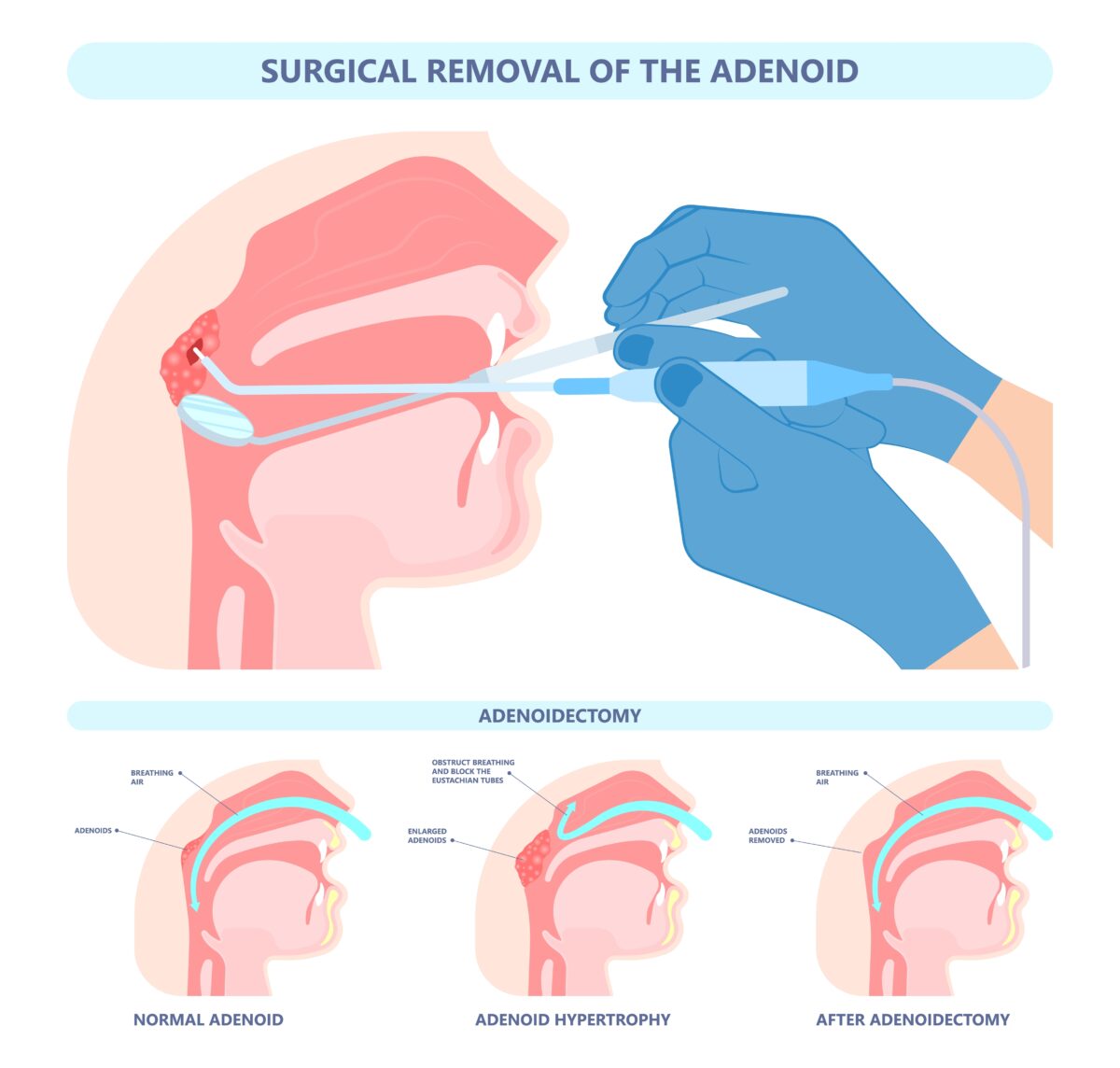 What You Need to Know About Tonsil and Adenoid Surgery | Annapolis and ...