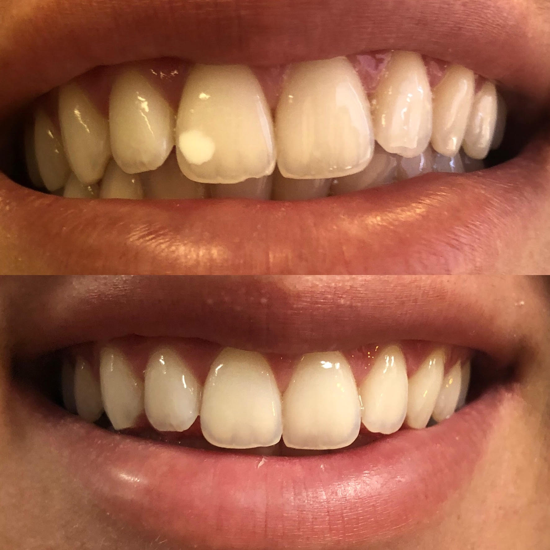 Icon Resin Infiltration • Amesbury, MA • Riverside Pediatric Dentistry