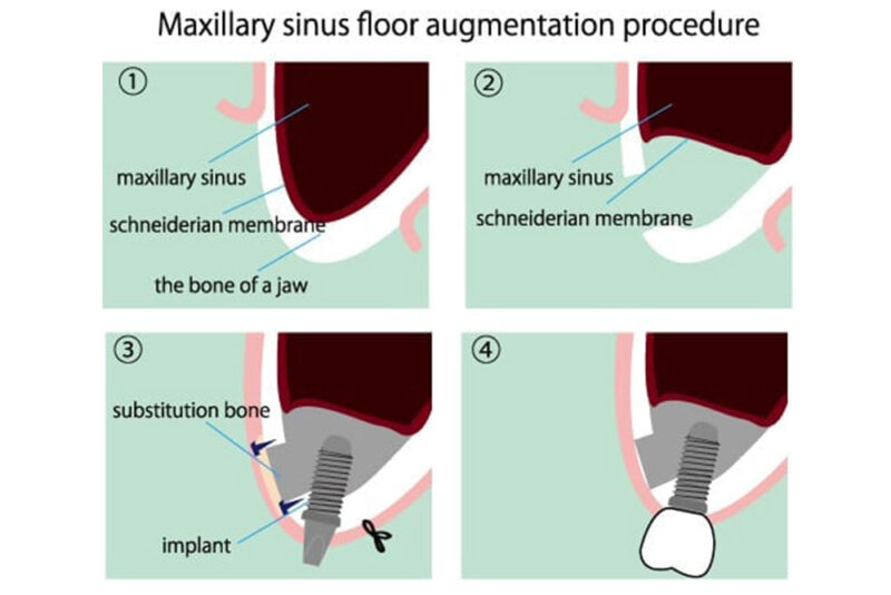 Sinus Augmentation | Gilbert, AZ | Synergy Periodontics & Implants