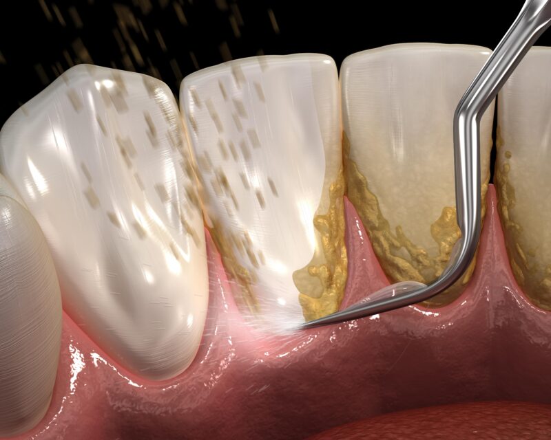 What is Periodontal Scaling and Planing? | Altoona, IA | Altoona Smiles
