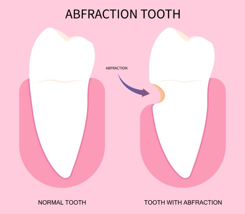 What is an Abfraction Lesion? | Altoona, IA | Altoona Smiles