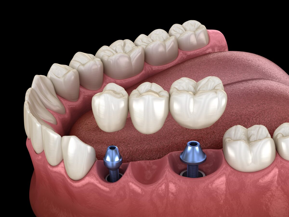 3 Types of Dental Prosthetics Supported by Dental Implants | Tallmadge ...