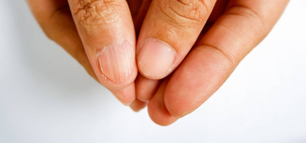 Nail Abnormalities | Monterey, CA | Parasol Dermatology