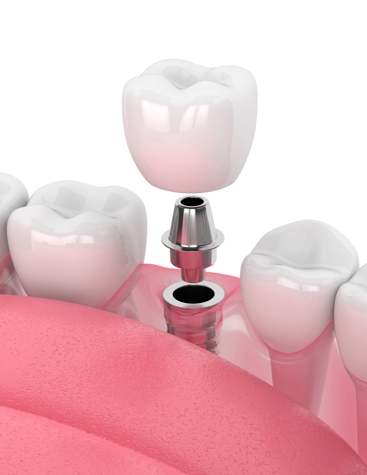 Holmdel Periodontics & Implant Dentistry | Monmouth County